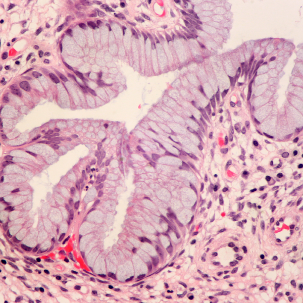 Polype du col de l'utérus | frequenz-therapie.com