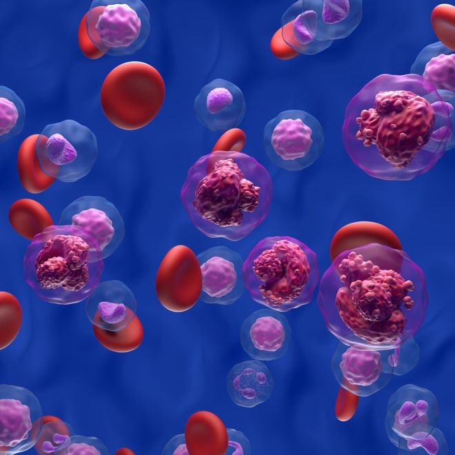 Leucemia linfoblástica aguda (LLA) y plasma | frequenz-therapie.com