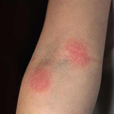 Mycosis fungoides | frequenz-therapie.com