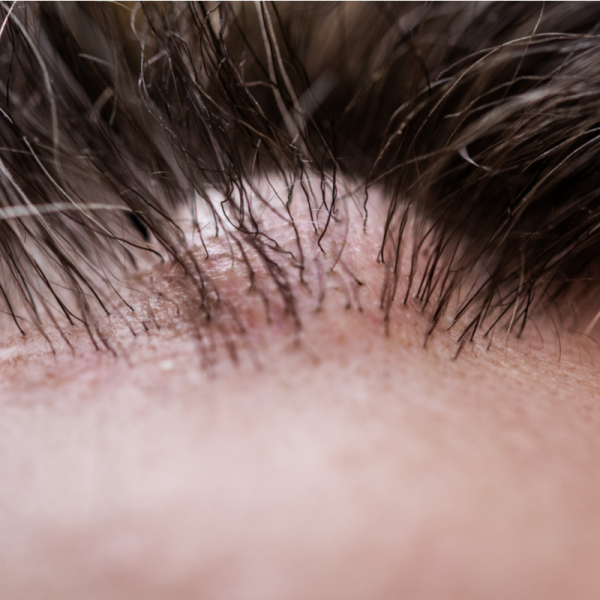 Lipom | frequenz-therapie.com