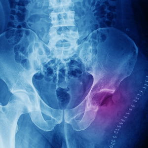 Knochenkrebs | frequenz-therapie.com