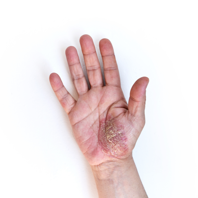 Sézary syndrome | frequenz-therapie.com