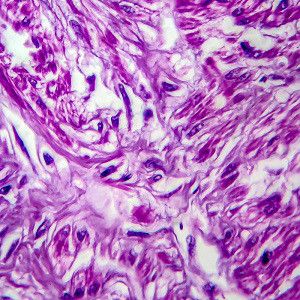 Myome et thérapie de fréquence | frequenz-therapie.com