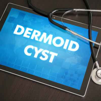 Cisto dermoide | frequenz-therapie.com